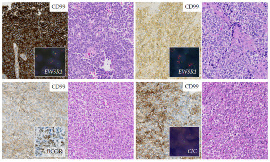 Ewing Sarcoma—Diagnosis, Treatment, Clinical Challenges and Future ...