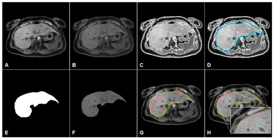 Assessment of Liver Fibrosis Stage Using Integrative Analysis of ...