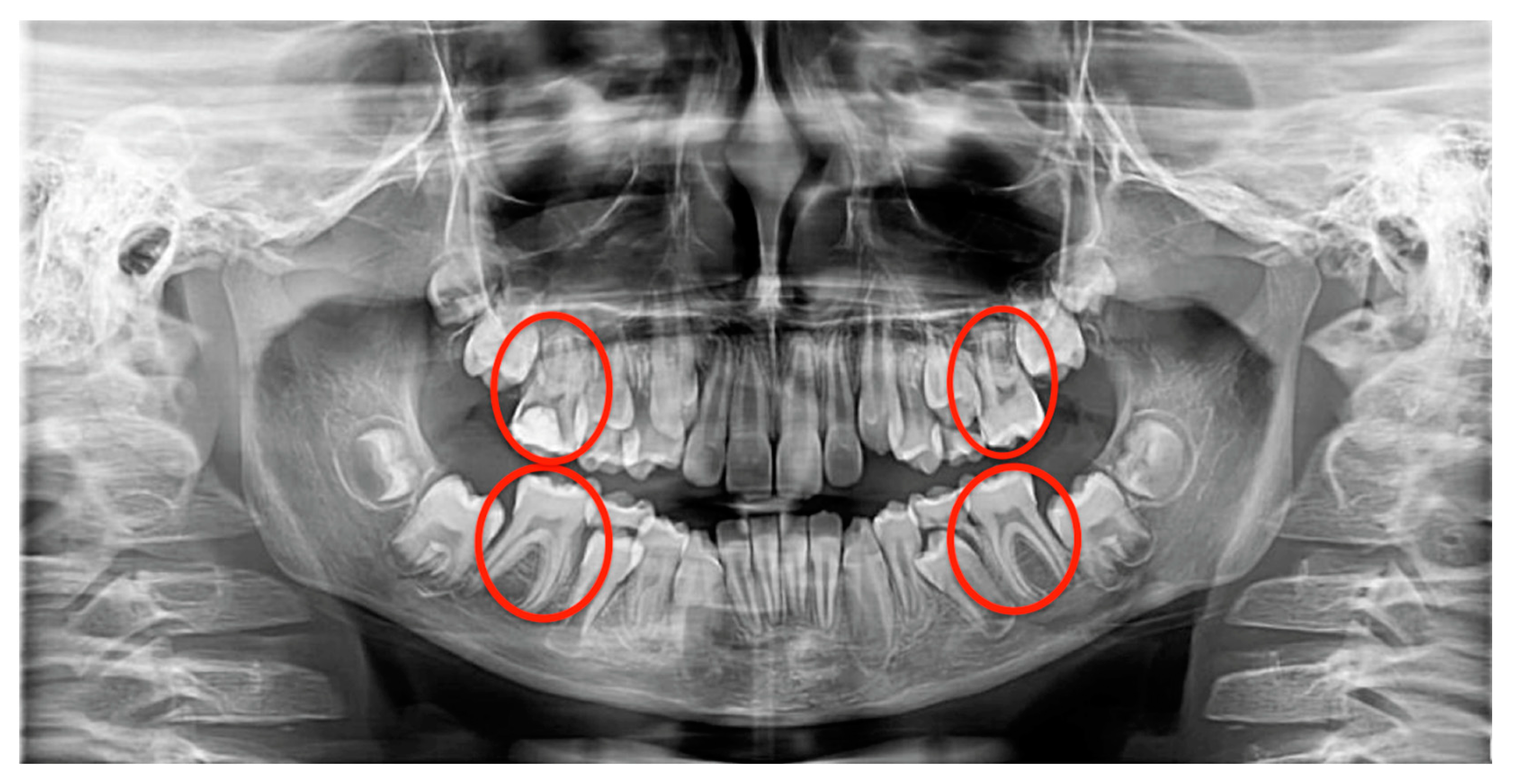 The Influence of Age on the Development of Dental Caries in Children. A ...