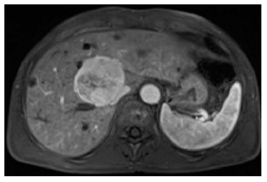 PEComa—A Rare Liver Tumor