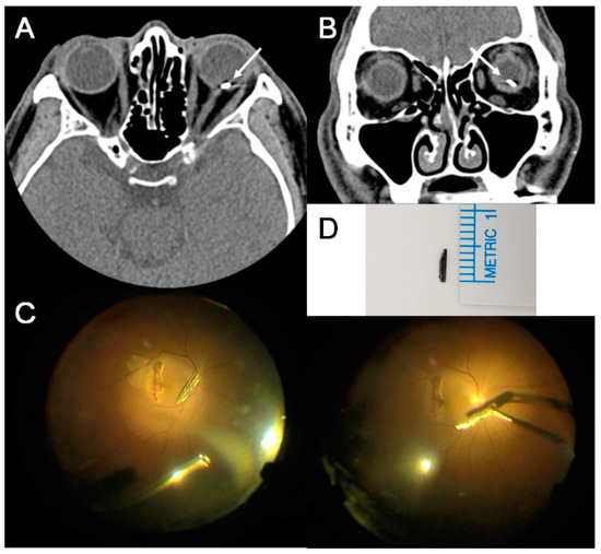 Intraocular Foreign Body: Diagnostic Protocols and Treatment Strategies ...
