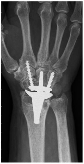 Proximal Row Carpectomy with Total Scapoidectomy vs. Conventional ...