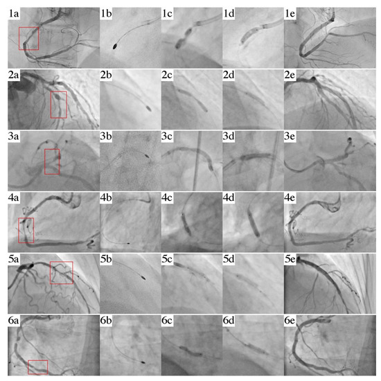 Rota-Lithotripsy—A Novel Bail-Out Strategy for Calcified Coronary ...