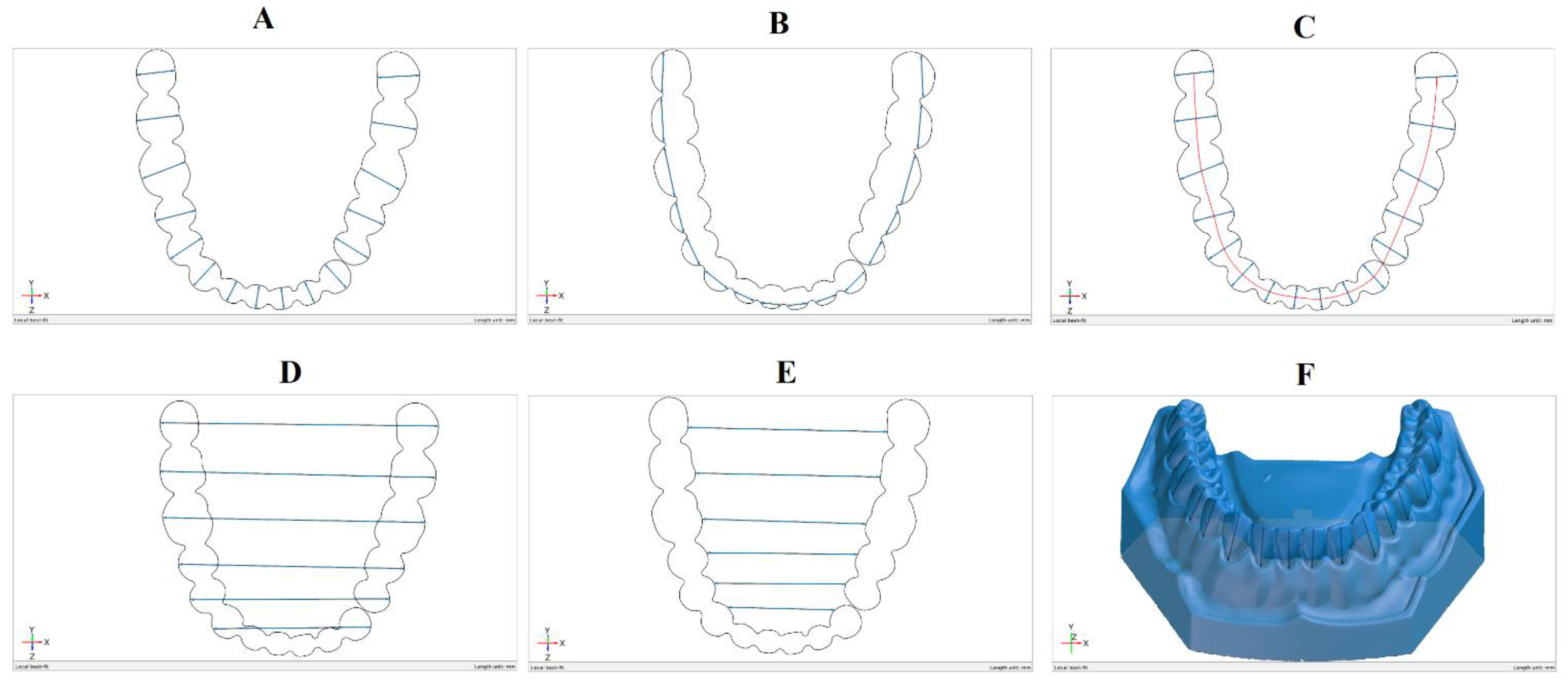 Accuracy of Three-Dimensional (3D) Printed Dental Digital Models ...