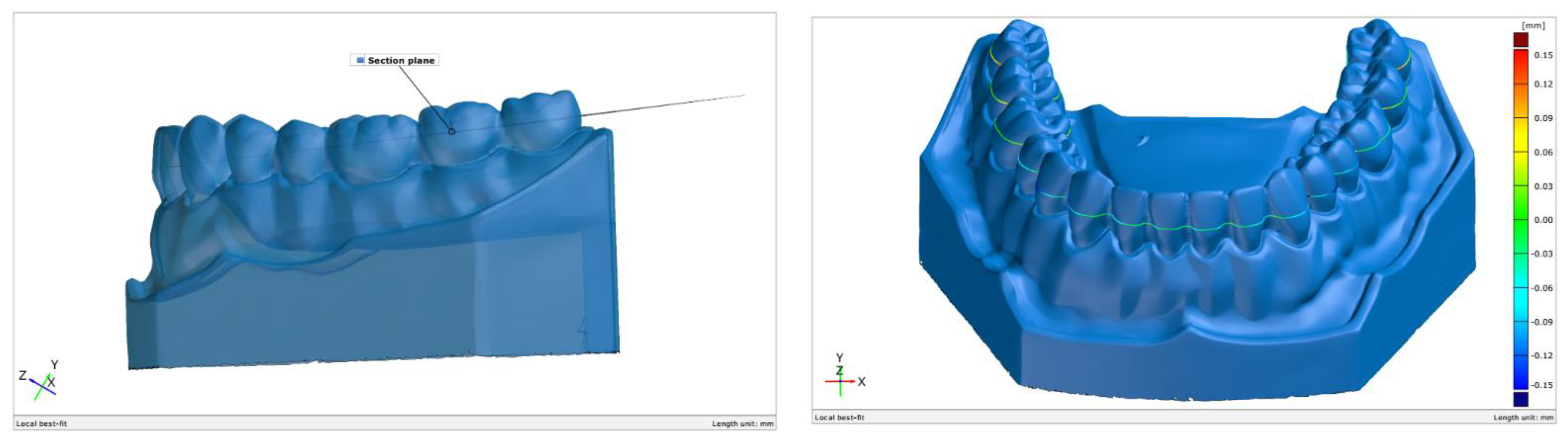 Accuracy of Three-Dimensional (3D) Printed Dental Digital Models ...