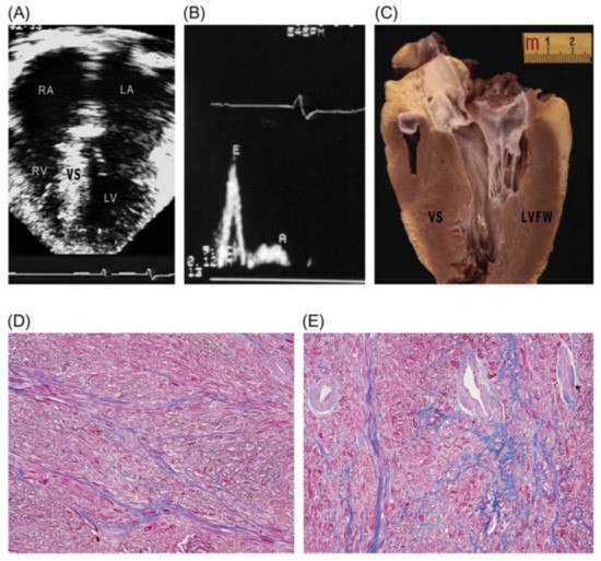 Restrictive Cardiomyopathy Histology