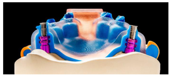 3D Printing in Digital Prosthetic Dentistry: An Overview of Recent ...
