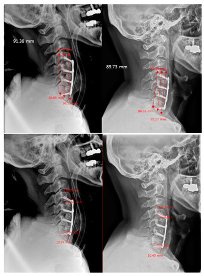 Short Plate with Screw Angle over 20 Degrees Improves the Radiologic ...
