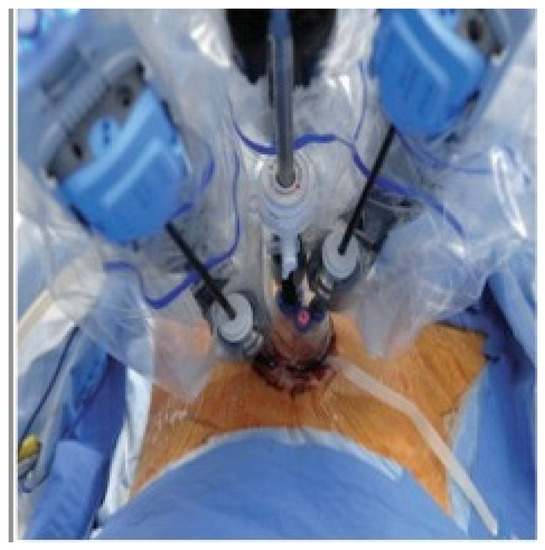 Laparoendoscopic Single Site Hysterectomy: Literature Review and Procedure Description