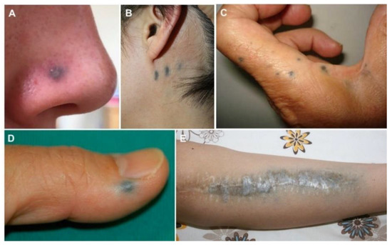 Clinical and Forensic Aspects of the Different Subtypes of Argyria