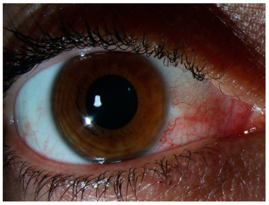 Episcleritis A Benign Inflammatory Eye Condition Before Episcleritis