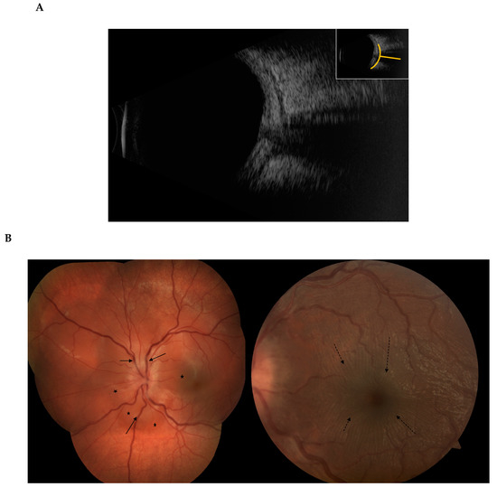 Rheumatoid Arthritis Associated Episcleritis and Scleritis: An Update ...