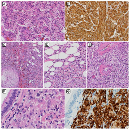 Feasibility and Long-Term Efficacy of PEComa Treatment—20 Years of ...
