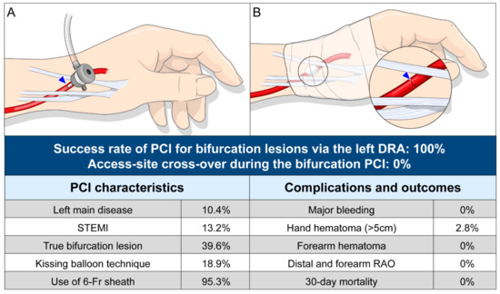 Feasibility and Safety of the Left Distal Radial Approach in ...