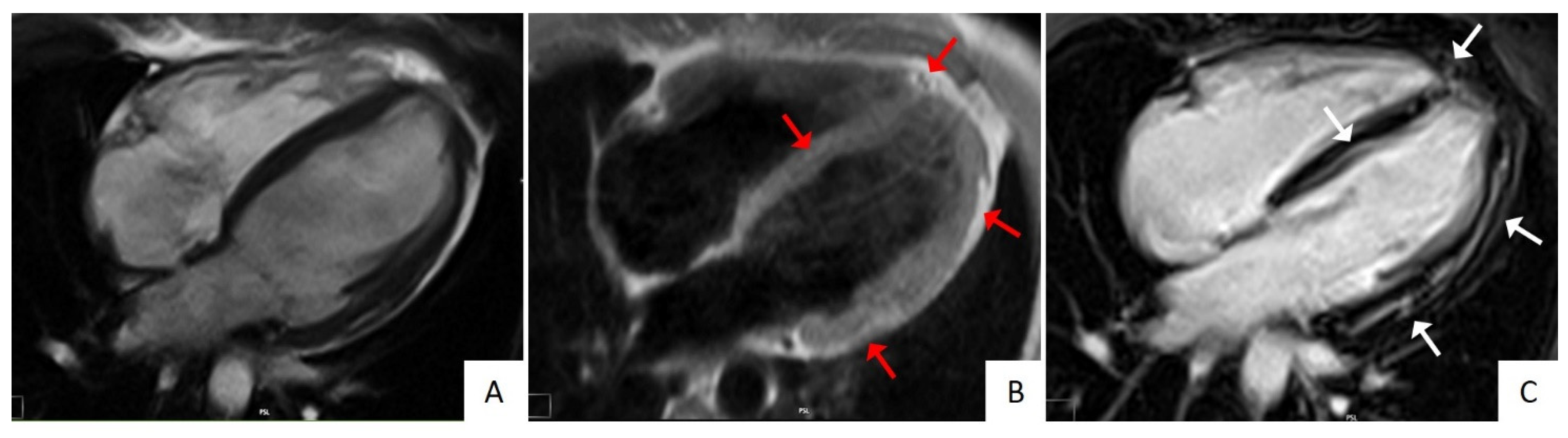 Arrhythmogenic Left Ventricular Cardiomyopathy: Genotype-Phenotype ...