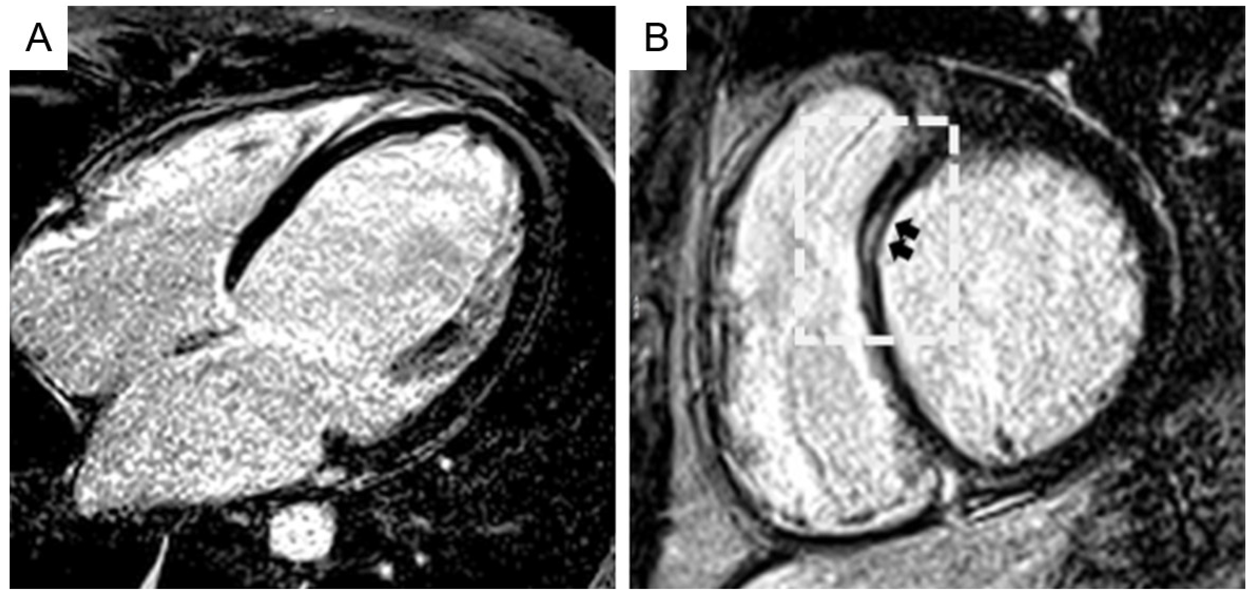 Arrhythmogenic Left Ventricular Cardiomyopathy: Genotype-Phenotype ...