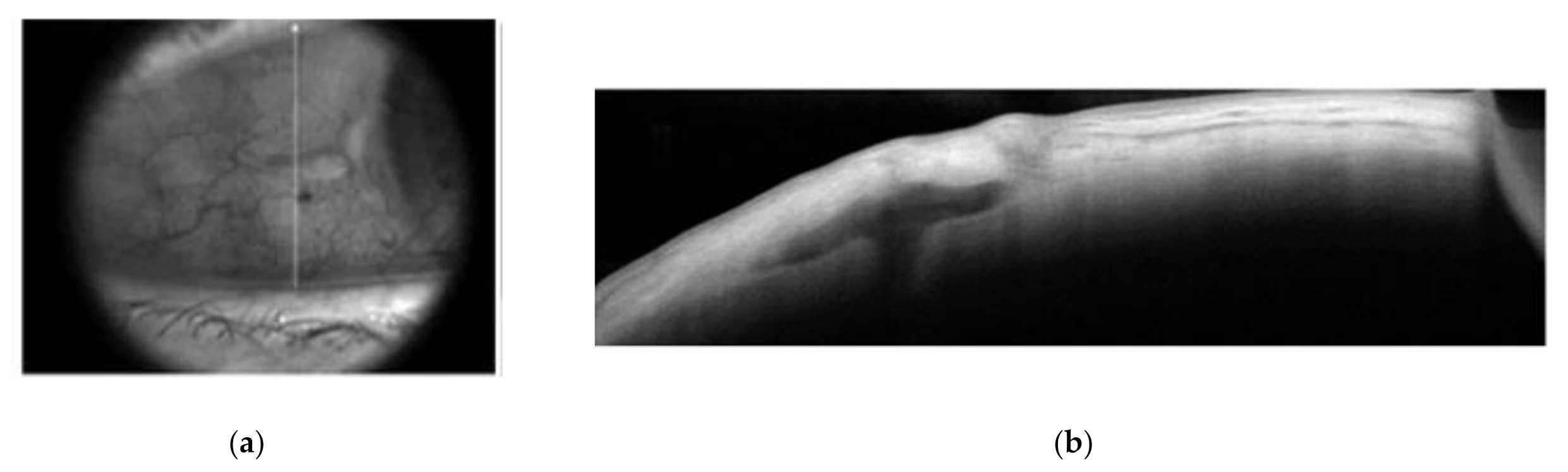 JCM | Free Full-Text | Secondary Sutureless Posterior Chamber Lens ...