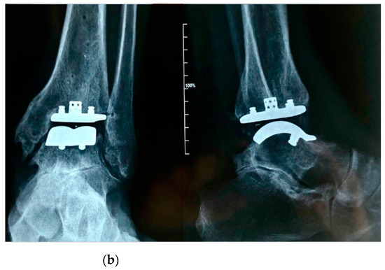 Clinical Radiographical Outcomes and Complications after a Brand-New ...