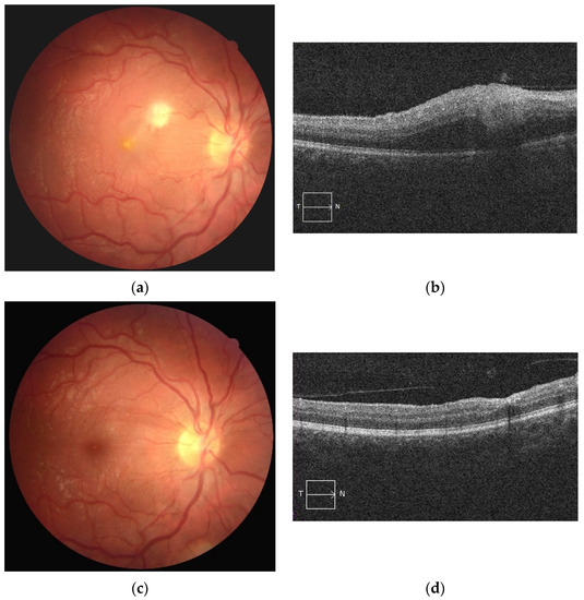Old and New Challenges in Uveitis Associated with Behçet’s Disease
