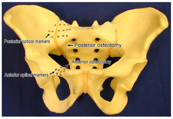 Biomechanical Comparison of Five Fixation Techniques for Unstable ...