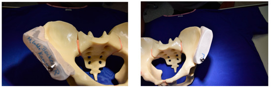Biomechanical Comparison of Five Fixation Techniques for Unstable ...