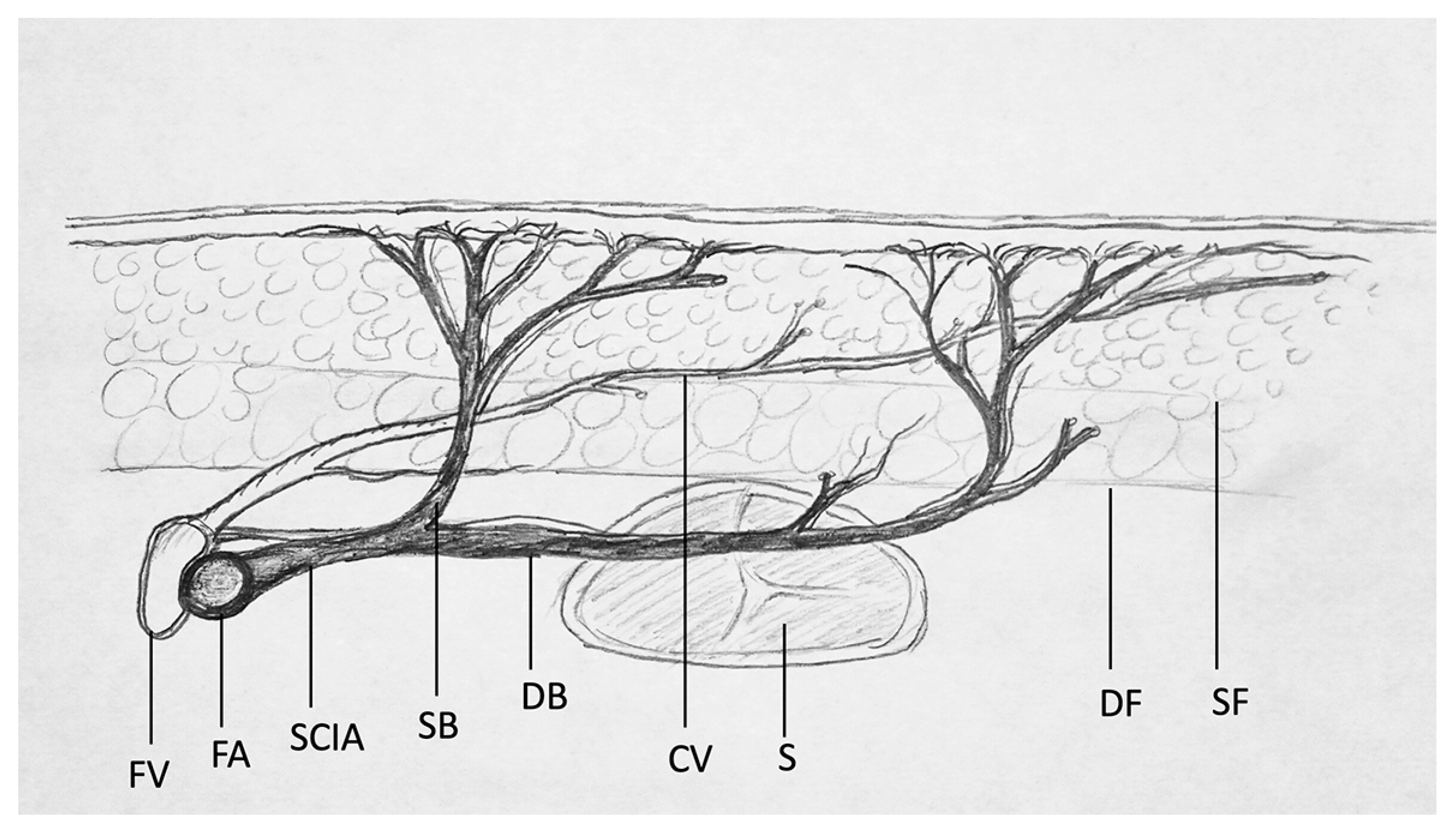 Do-It-Yourself Preoperative High-Resolution Ultrasound-Guided Flap ...