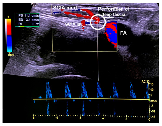 Do-It-Yourself Preoperative High-Resolution Ultrasound-Guided Flap ...