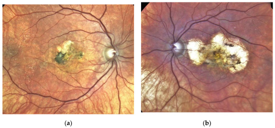 Visual Outcome after Intravitreal Anti-VEGF Therapy for Macular ...