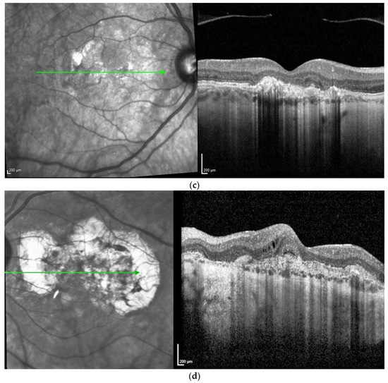 Visual Outcome after Intravitreal Anti-VEGF Therapy for Macular ...