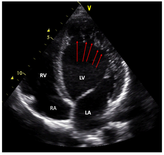 Noncompaction Cardiomyopathy—History and Current Knowledge for Clinical ...