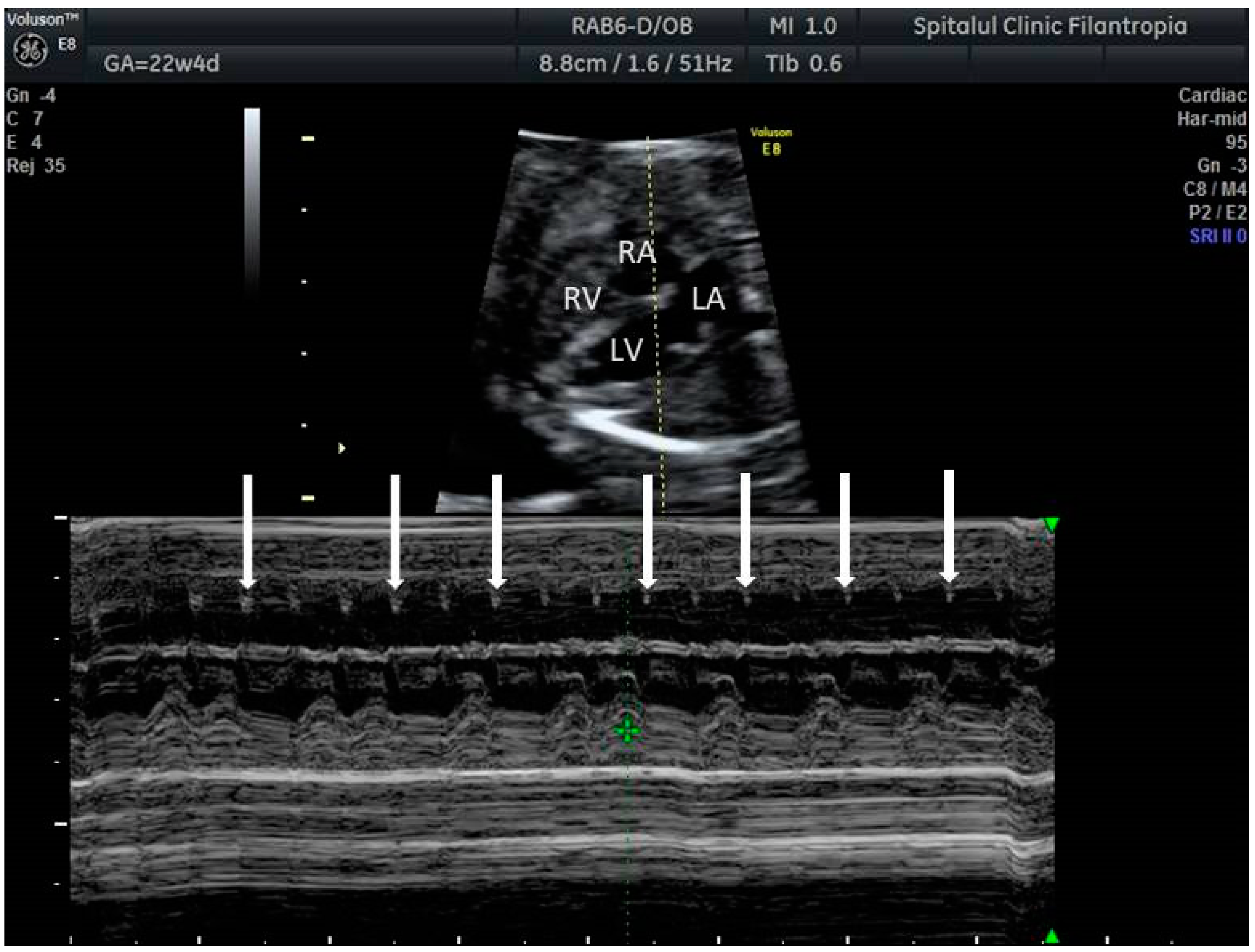 Treatment of Fetal Arrhythmias