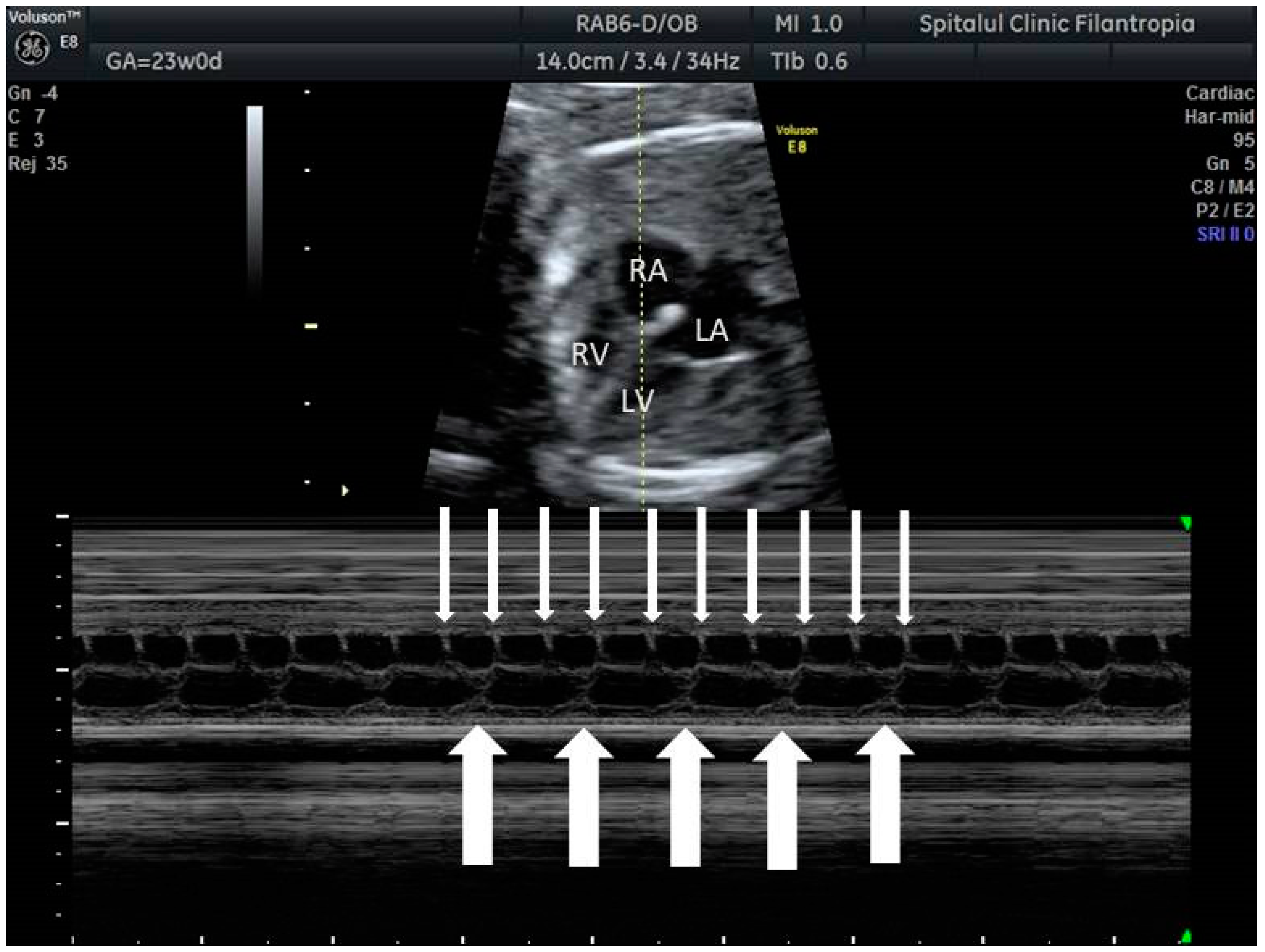 Treatment of Fetal Arrhythmias