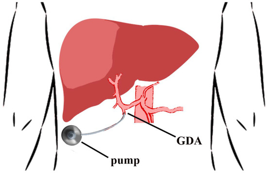 JCM | Free Full-Text | Hepatic Arterial Infusion Chemotherapy for Unresectable Intrahepatic ...