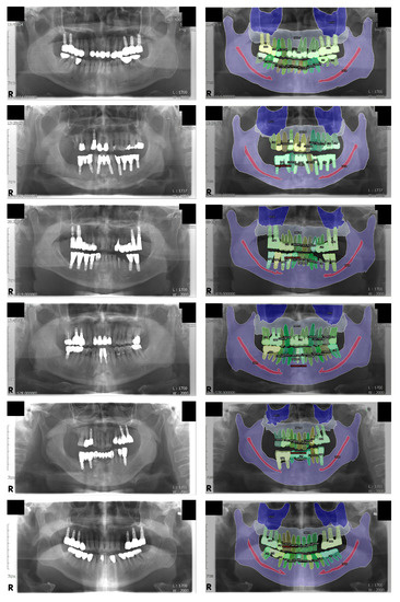 Panoptic Segmentation on Panoramic Radiographs: Deep Learning-Based ...
