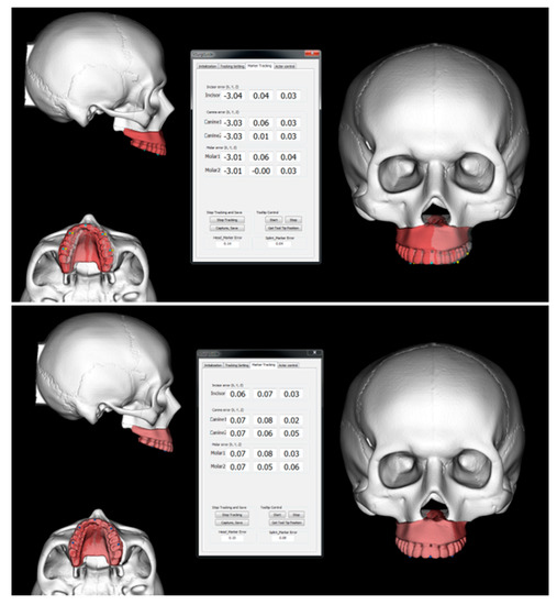 Robot-Assisted Maxillary Positioning in Orthognathic Surgery: A ...