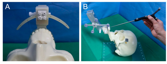 Robot-Assisted Maxillary Positioning in Orthognathic Surgery: A ...