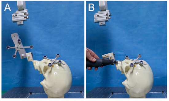 Robot-Assisted Maxillary Positioning in Orthognathic Surgery: A ...