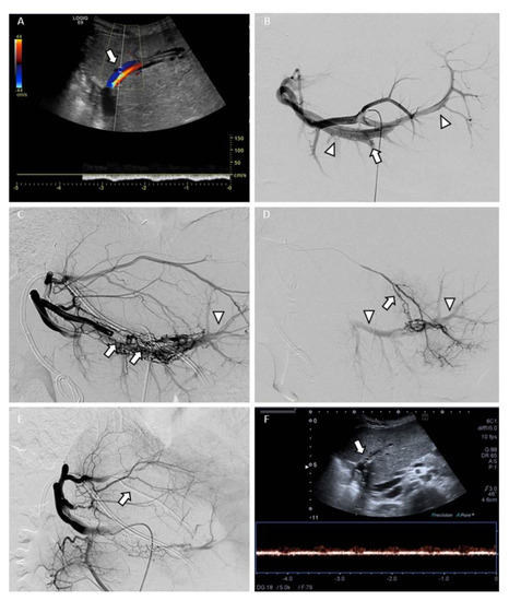 JCM | Special Issue : Embolization Techniques: State of the Art and ...