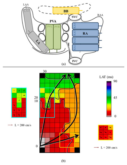 Reduction of Conduction Velocity in Patients with Atrial Fibrillation