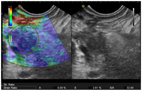 Diagnostic and Interventional Role of Endoscopic Ultrasonography for the Management of ...