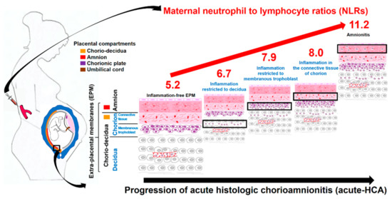 Neutrophil to Lymphocyte Ratio in Maternal Blood: A Clue to Suspect ...