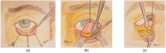 JCM | Free Full-Text | Transconjunctival and Subciliary Approach in the Treatment of Orbital ...
