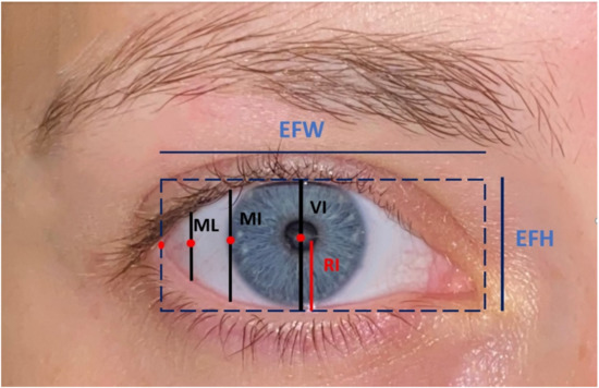 JCM | Free Full-Text | Transconjunctival and Subciliary Approach in the ...