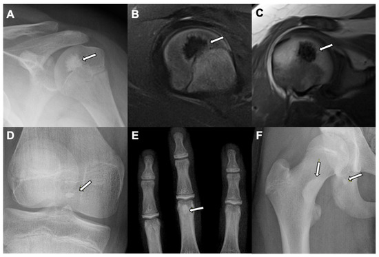 Imaging Review of Pediatric Benign Osteocytic Tumors and Latest Updates ...