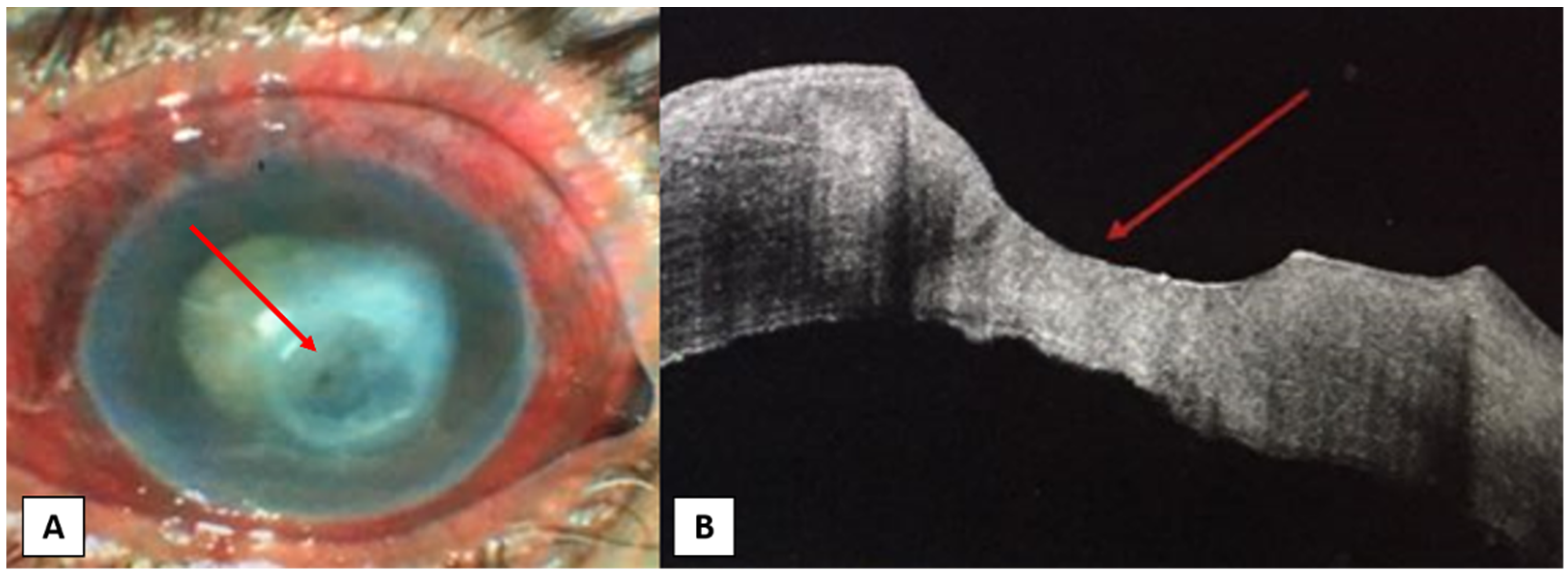 Corneal Opacity Types
