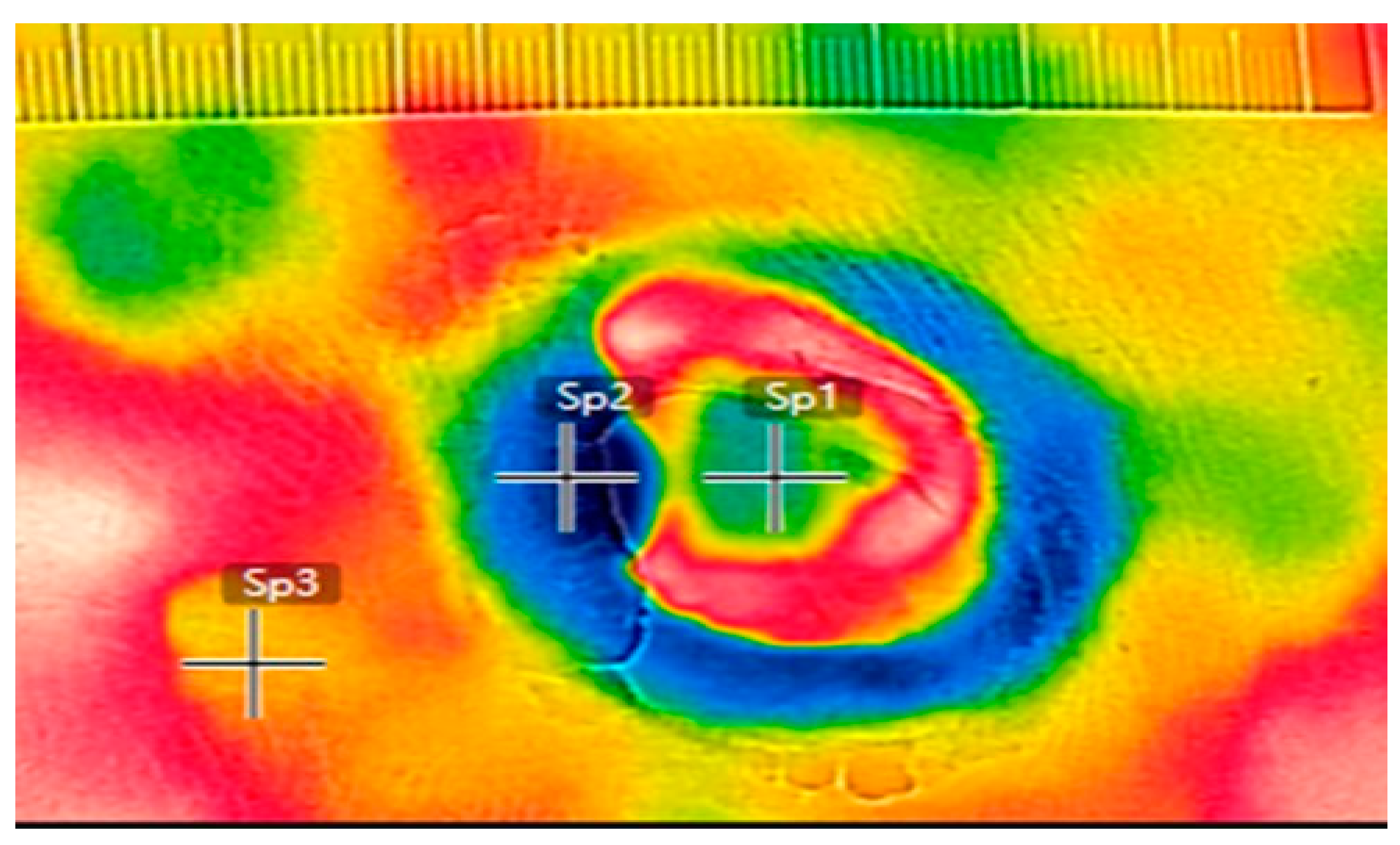 Higher Periwound Temperature Associated with Wound Healing of Pressure ...