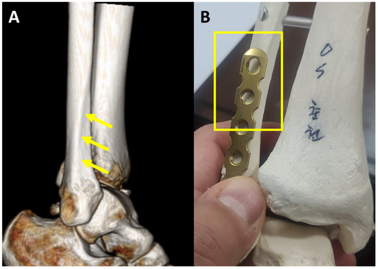 JCM | Free Full-Text | Three-Dimensional Anatomically Pre-Contoured ...