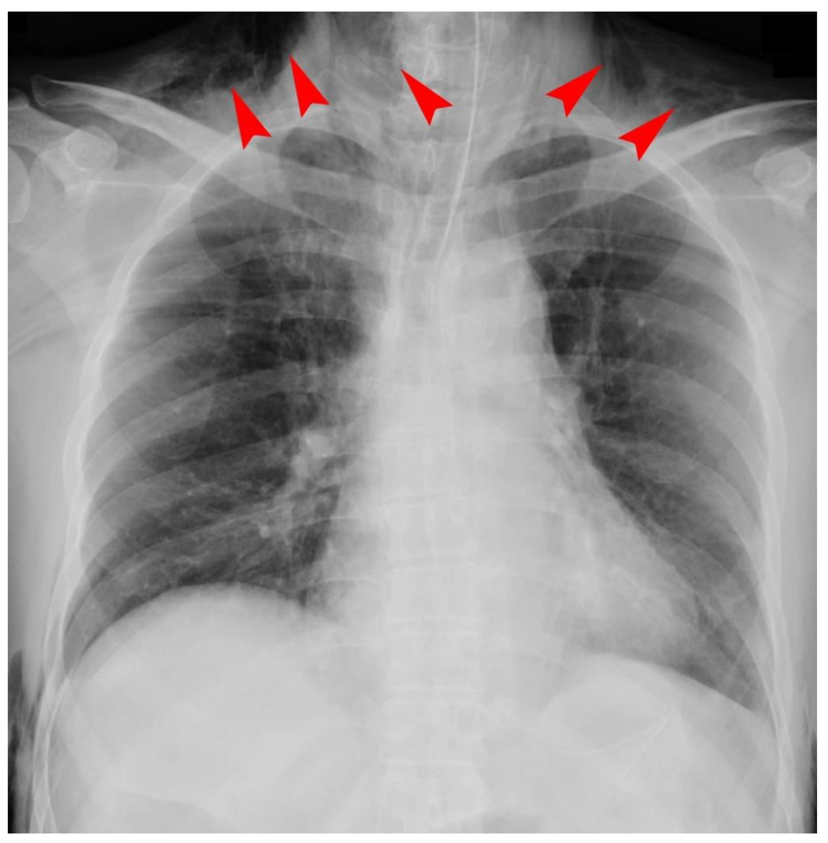 Subcutaneous Emphysema X Ray - vrogue.co Subcutaneous Emphysema X Ray - vrogue.co