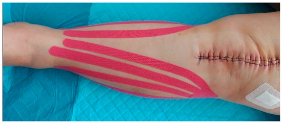 A Kinesio Taping Method Applied in the Treatment of Postsurgical Knee ...