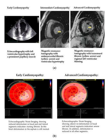 Fabry Cardiomyopathy: Current Treatment and Future Options